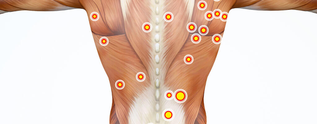 Trigger Point Therapy Del Mar, CA - Performance RefineryPerformance ...